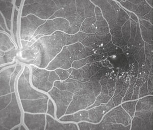Macular Edema | Star Retina